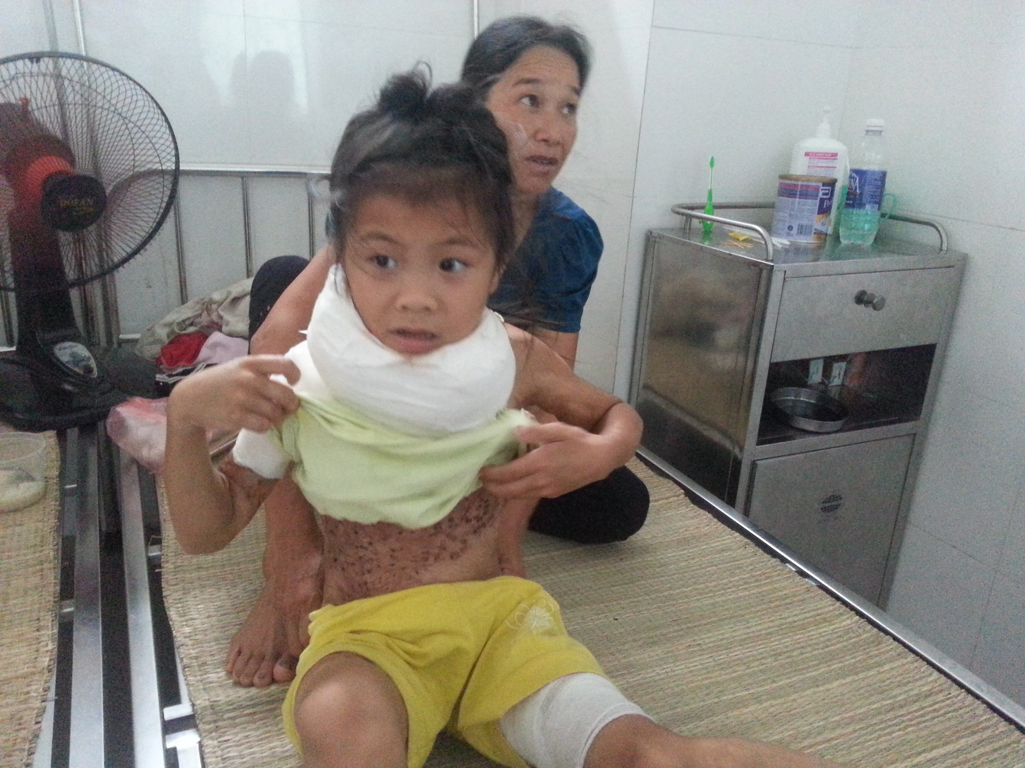 Côi cút cảnh bà nội suốt 2 năm chăm cháu bị bỏng đến… dị dạng