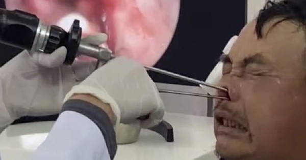 Hay làm điều này, người đàn ông bị 100 con giòi làm tổ trong mũi