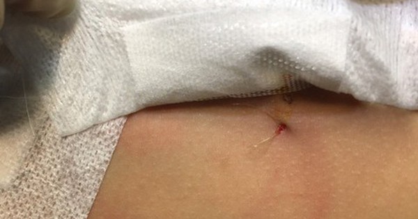 Bé 4 tuổi vỡ ruột vì bị anh trai ném lon bia trúng bụng